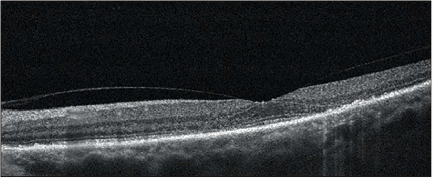 [OCT Article] The Subtle Things Matter When It Comes to Certain Retinal ...
