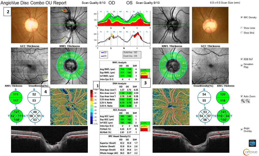 [OCT Observations] Optovue Solix Glaucoma Protocol #2 J.Rodman