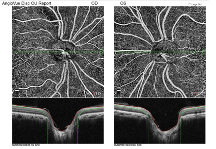[OCT Observations] Optovue Solix Glaucoma Protocol #2 J.Rodman