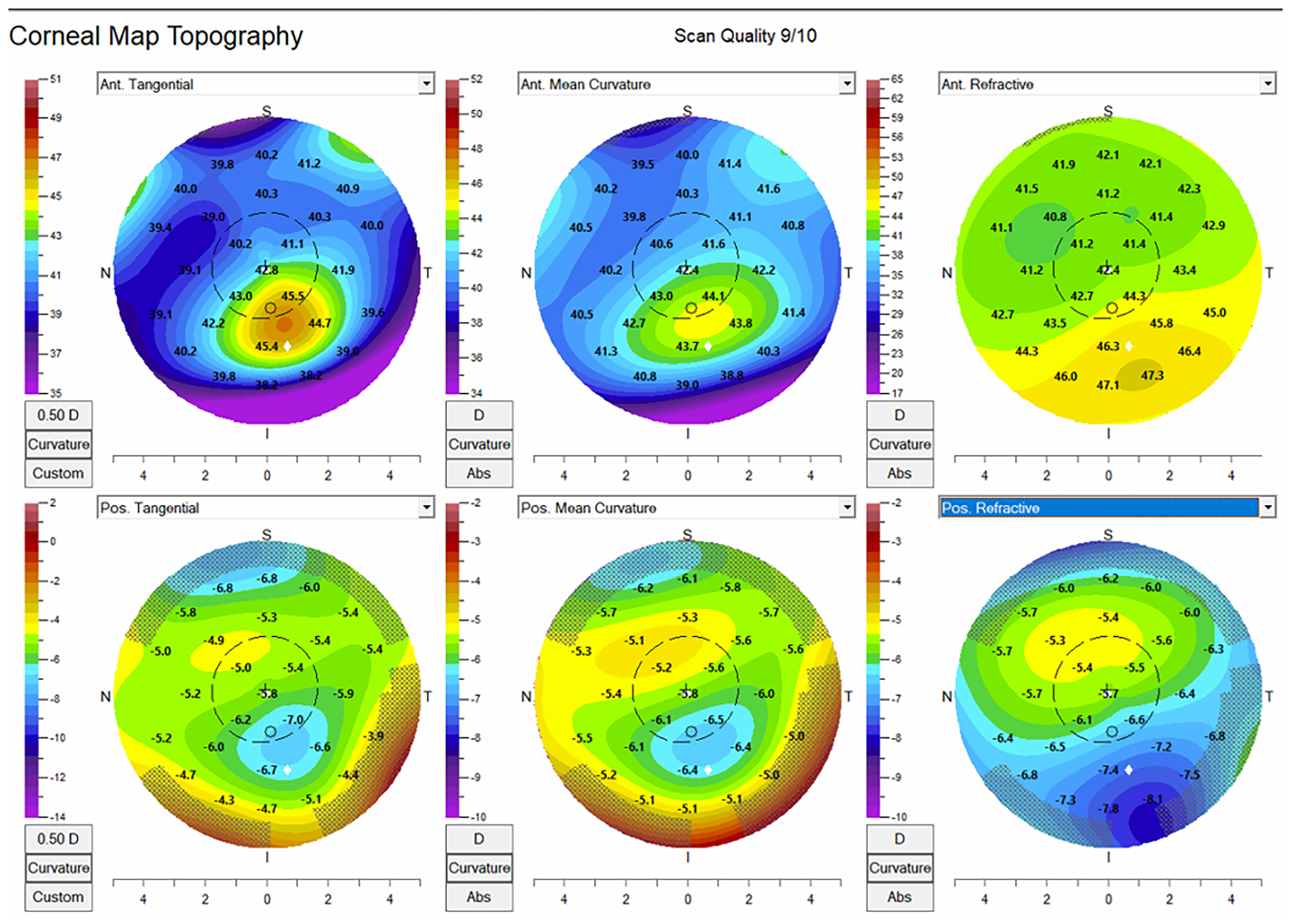 Case Study: Multiple Imaging Techniques to Detect Corneal Irregularities