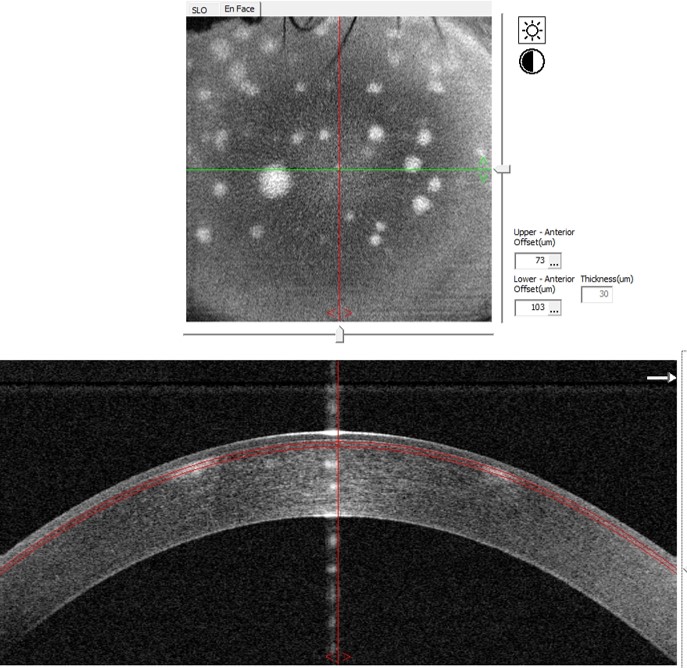 [OCT Article] Multimodal OCT Imaging of Adenovirus Keratitis by Adil El ...