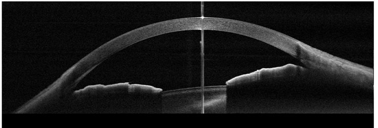 [OCT Observations] Utilizing Full-Range Anterior Chamber Scans in the ...