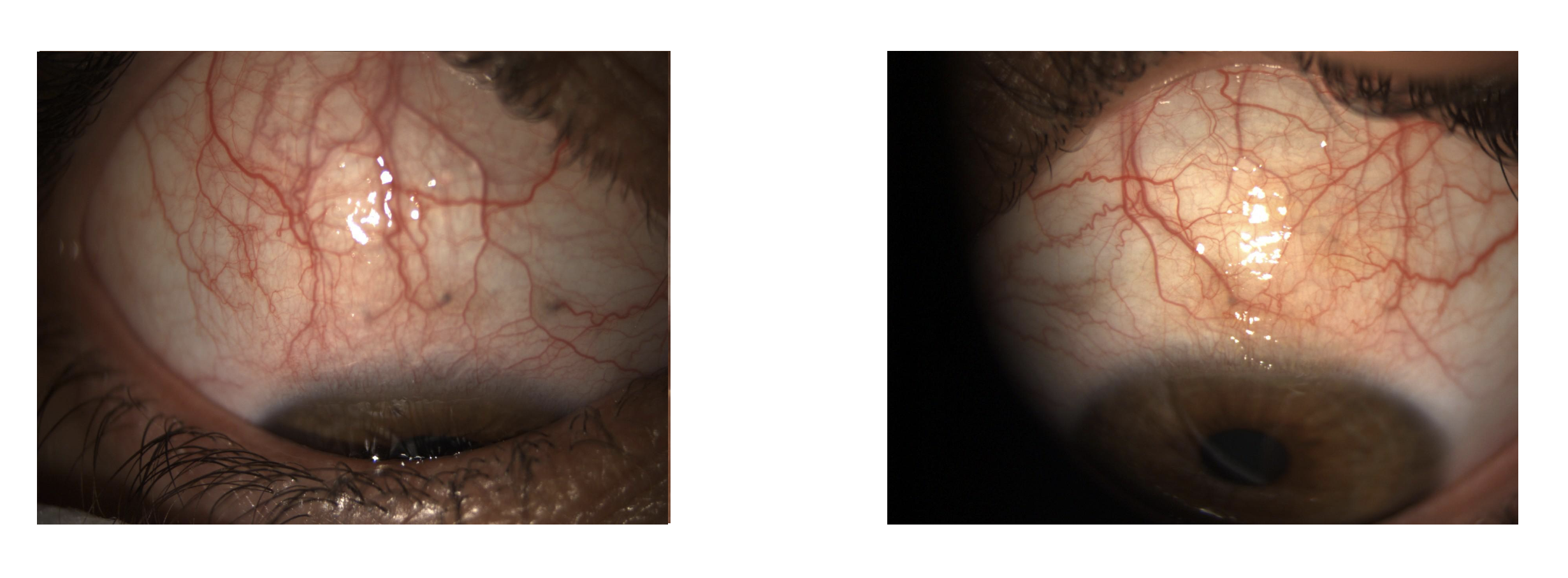 Présentation d'un cas de kératoconjonctivite limbique supérieure