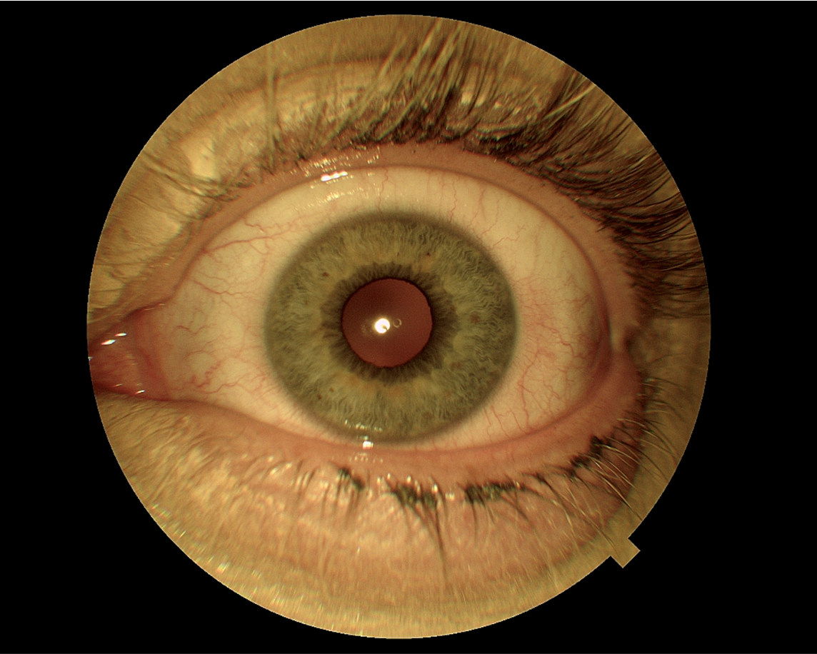 [OCT Article] Advanced Diagnostics Help Advanced Treatments by Mile ...