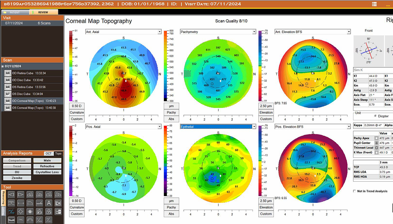 [OCT Press release] Optovue Solix Topography