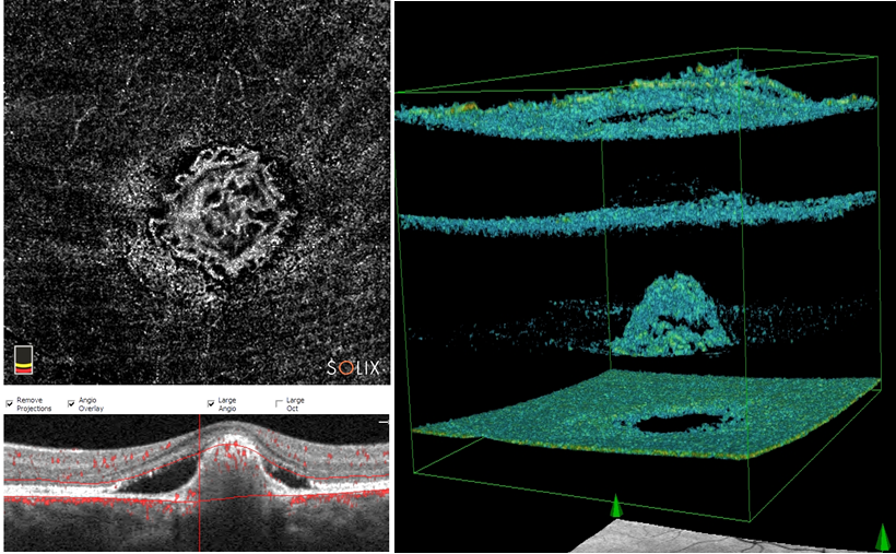OCT-A, developed by Optovue, marks ten years of innovation