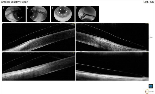 Case Study: Scleral Lens Simplicity: Utilizing Anterior Segment OCT for ...