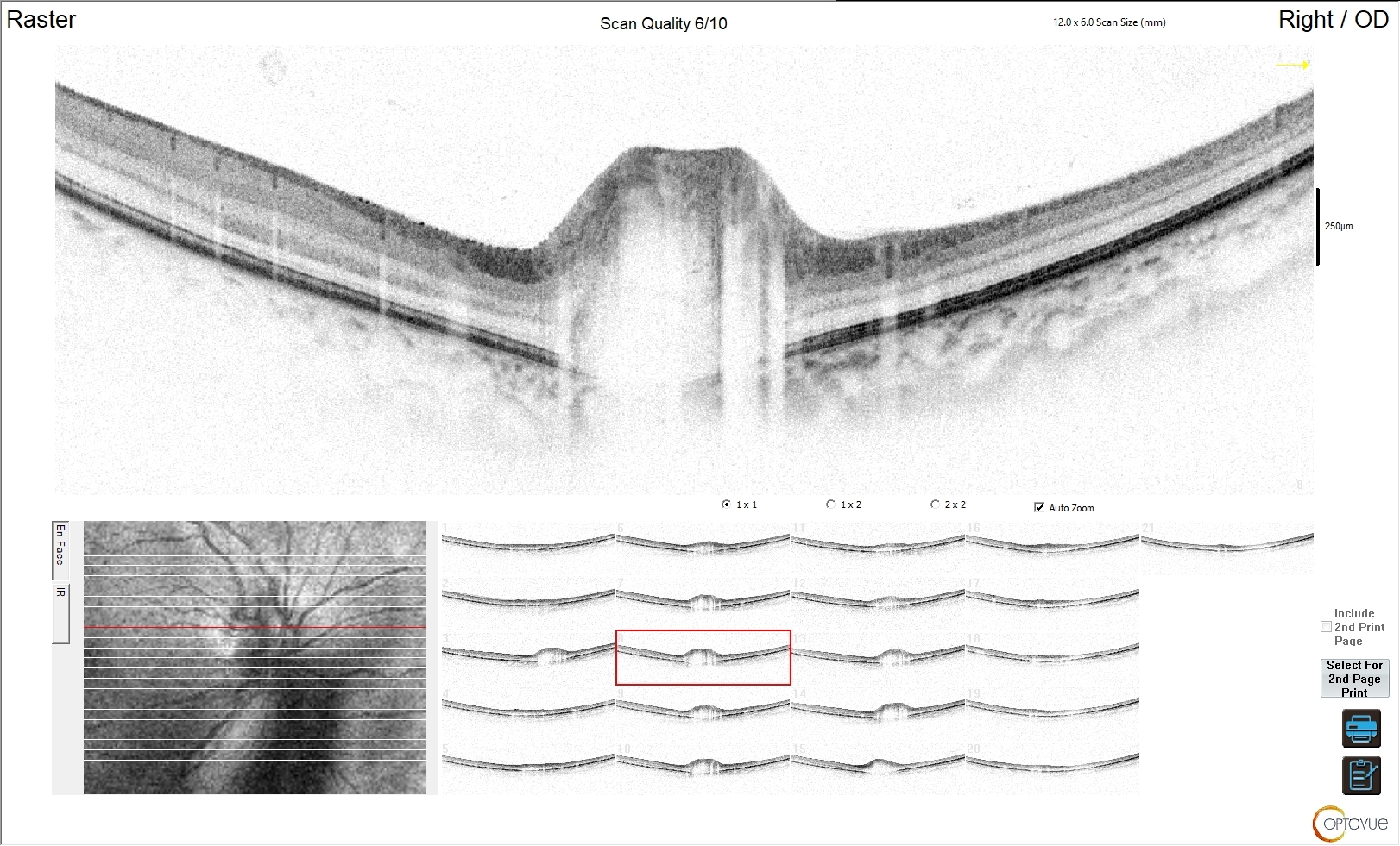 [OCT Article] Case Study: Advanced OCT Diagnostics for Buried Optic ...