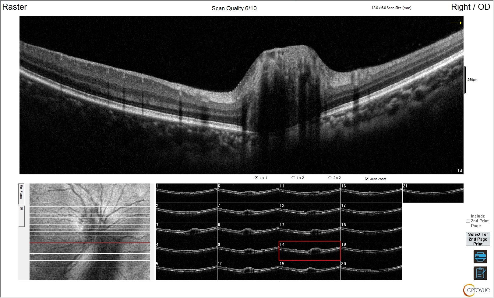 [OCT Article] Case Study: Advanced OCT Diagnostics for Buried Optic ...