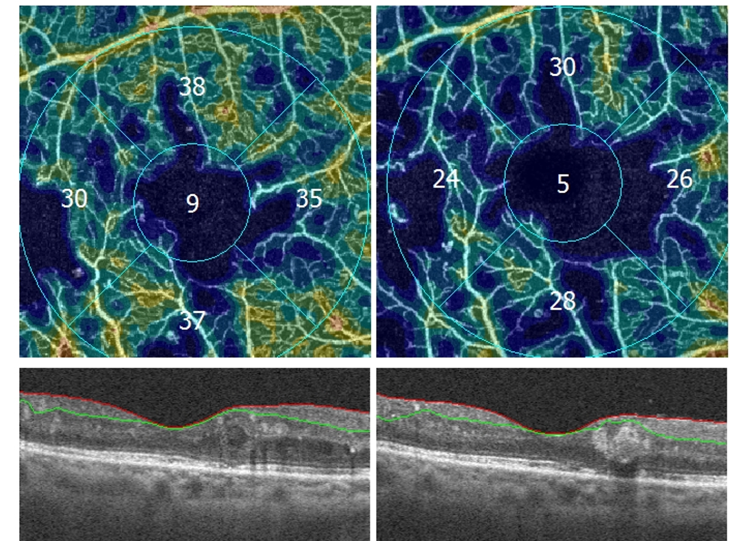 [OCT Observations] OCT-A and Diabetic Retinopathy