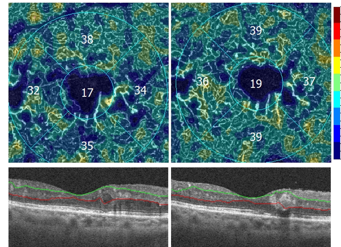 [OCT Observations] OCT-A and Diabetic Retinopathy