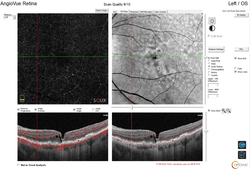 [OCT Article] Choroidal Neovascularization with Optovue Solix