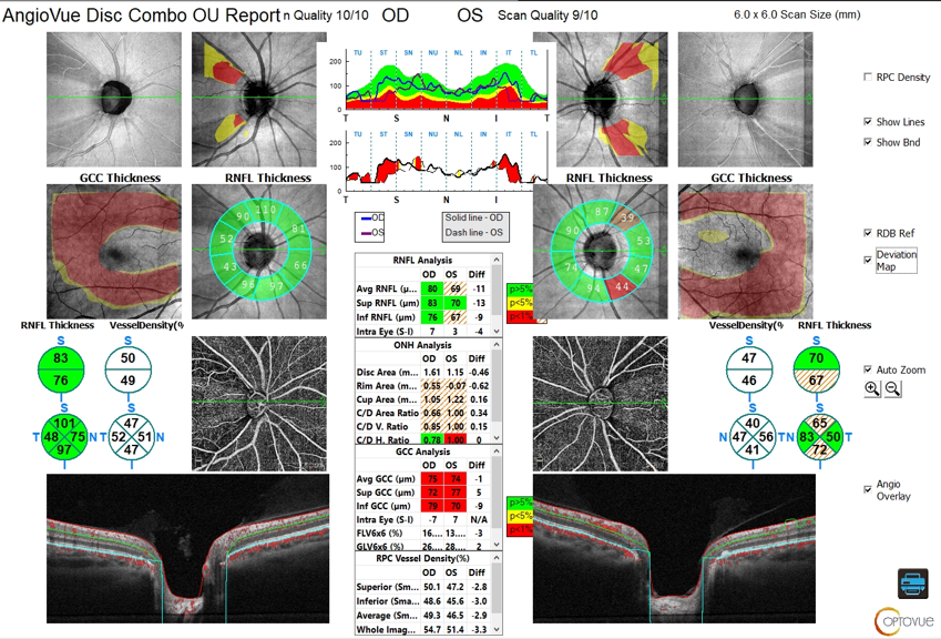 [OCT Article] Unraveling Green Disease with the Optovue Solix AngioVue ...