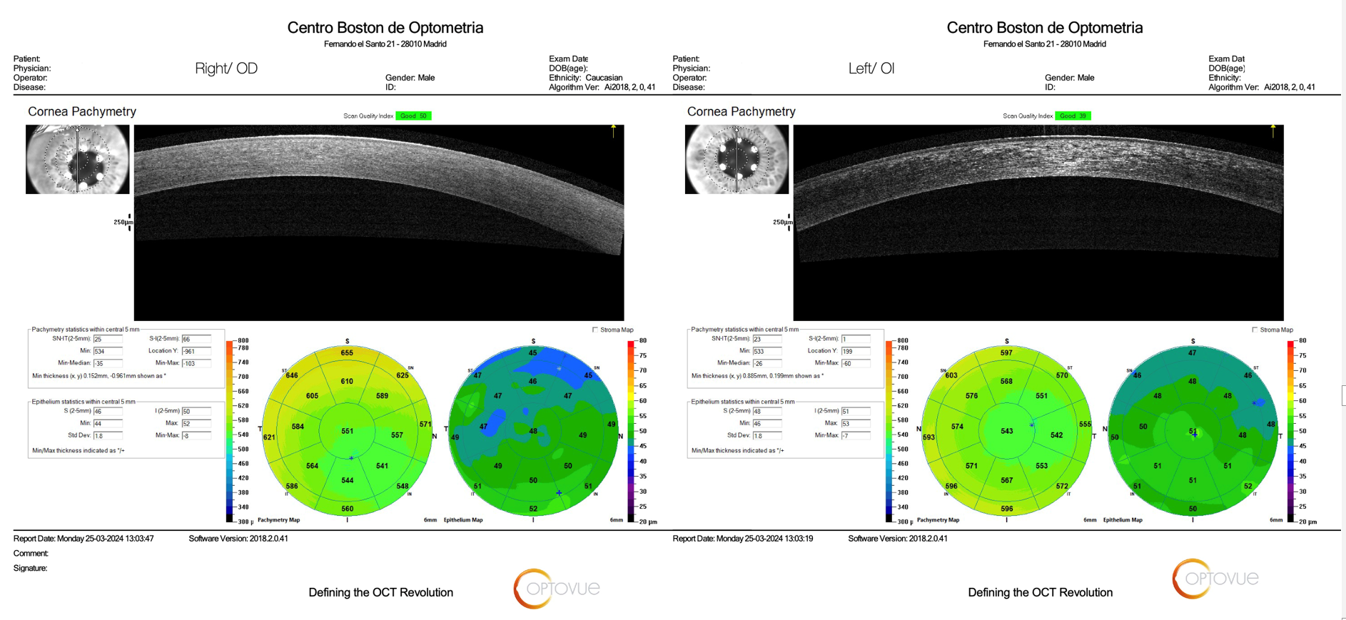 [OCT Article] Dry eye and irregular epithelial thickness map
