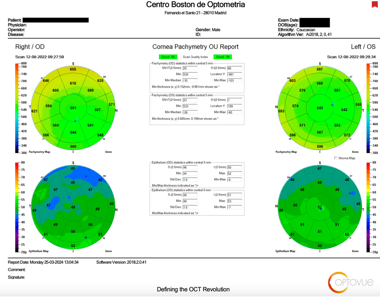 [OCT Article] Dry eye and irregular epithelial thickness map