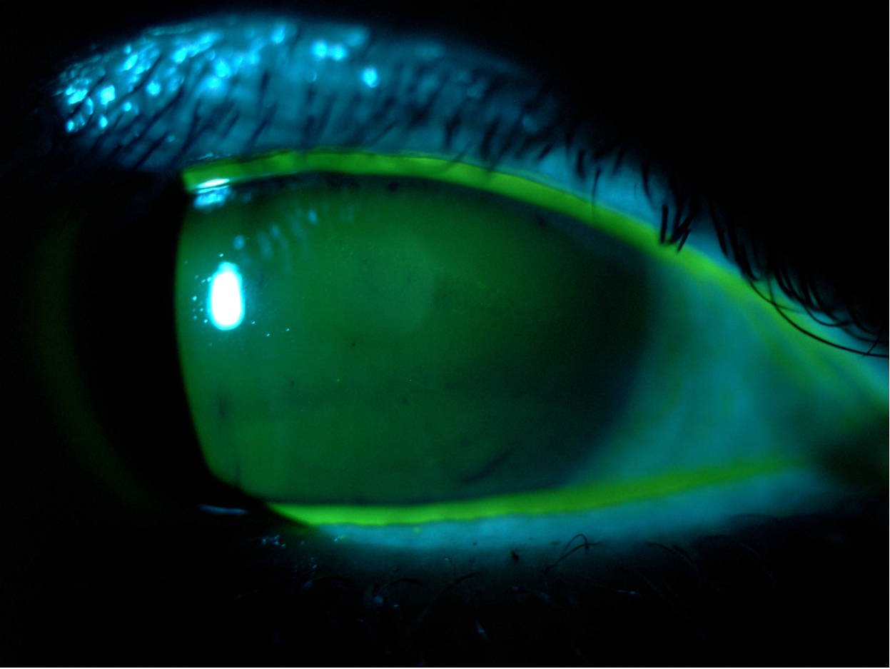 [OCT Article] Dry eye and irregular epithelial thickness map