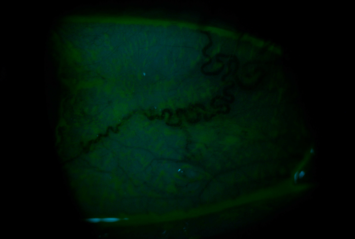 [OCT Article] Dry eye and irregular epithelial thickness map
