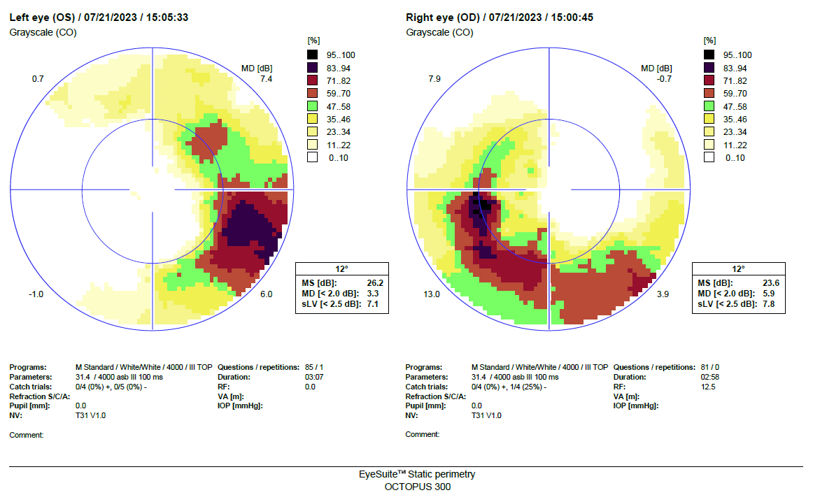 [OCT Article] Unraveling Green Disease with the Optovue Solix AngioVue ...