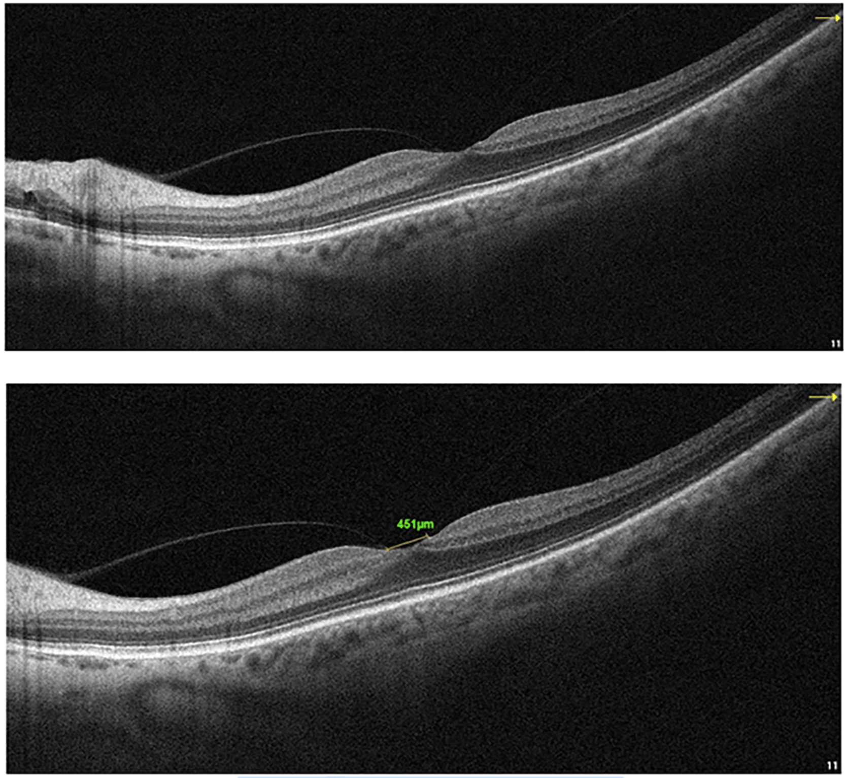 [OCT Article] Vitreous: Friend or Foe