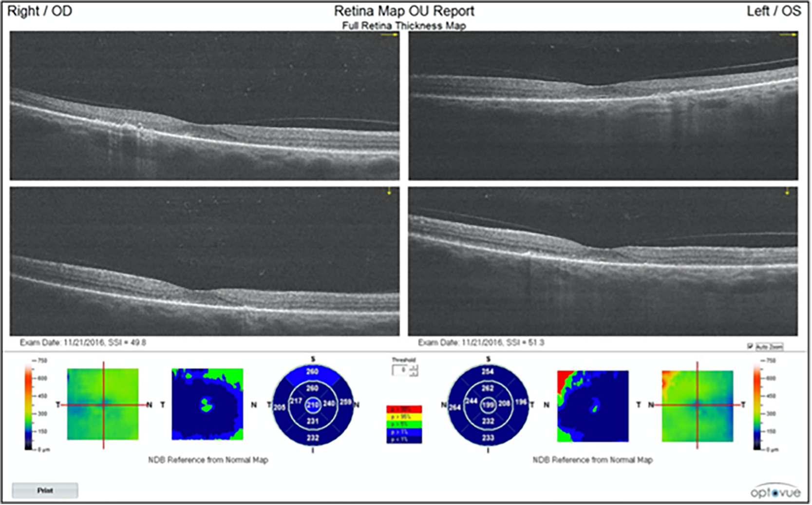 [OCT Article] The Subtle Things Matter When It Comes to Certain Retinal ...