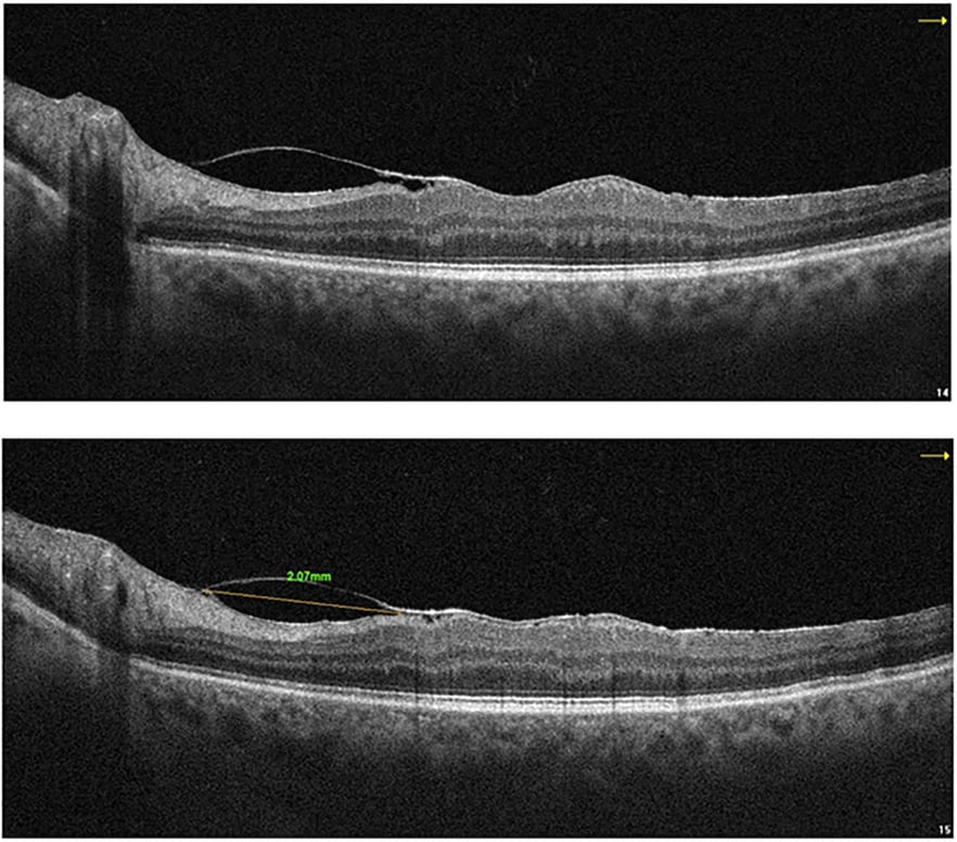 [OCT Article] Vitreous: Friend or Foe