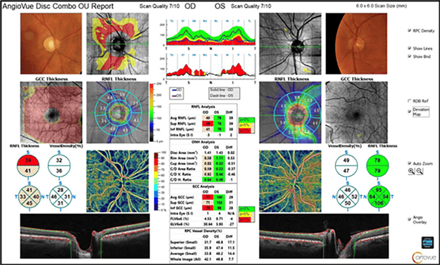 [OCT Article] Comprehensive OU Report for Glaucoma Management Enhances ...