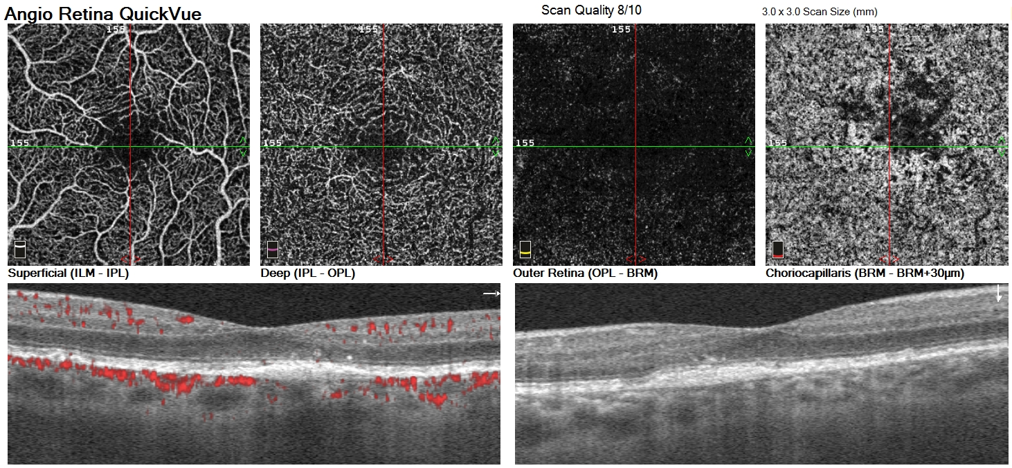 OCT vs. OCT-A: Assess retinal structure and function with advanced ...