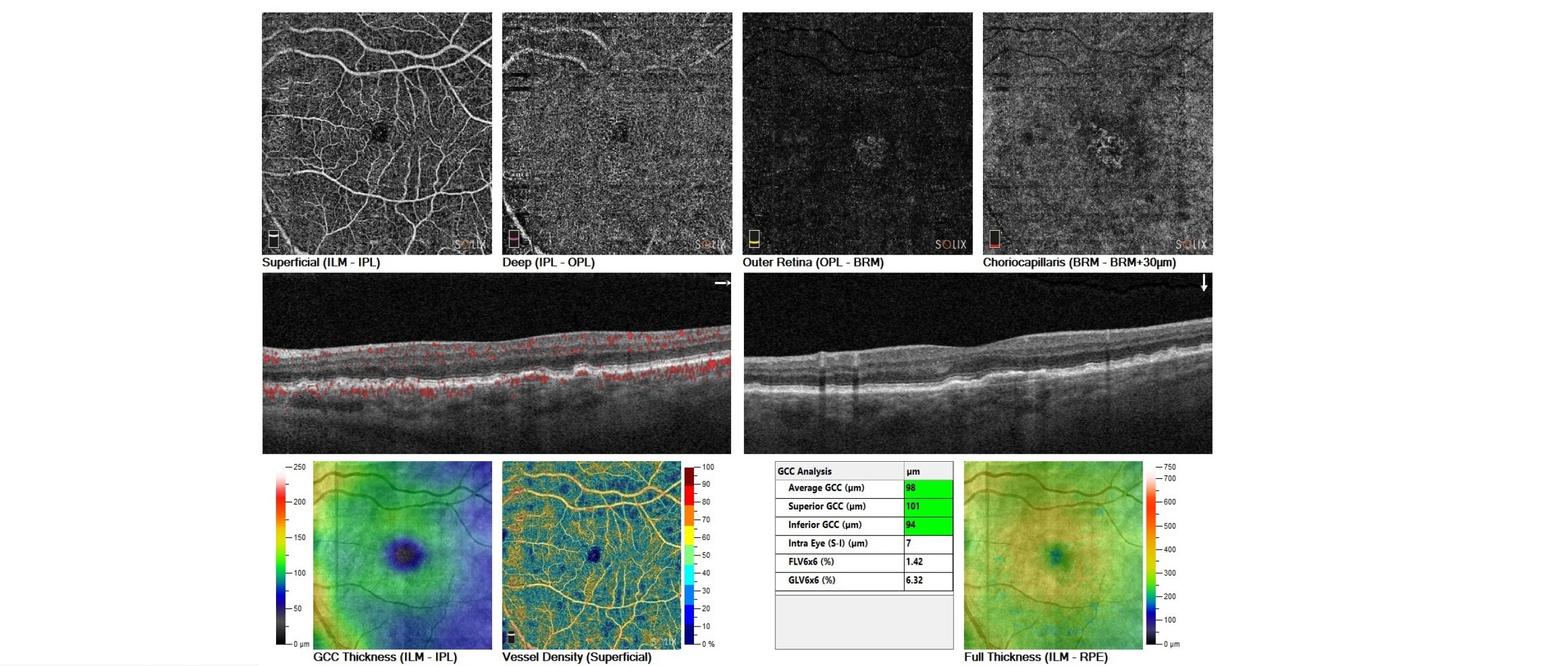 Case Study: Advanced AMD Monitoring using OCT-A
