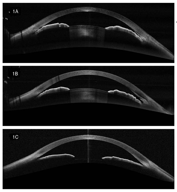 [OCT Observations] Utilizing Full-Range Anterior Chamber Scans in the ...