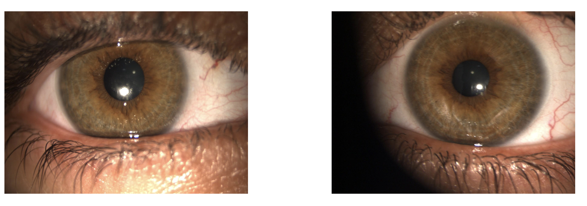 Présentation d'un cas de kératoconjonctivite limbique supérieure