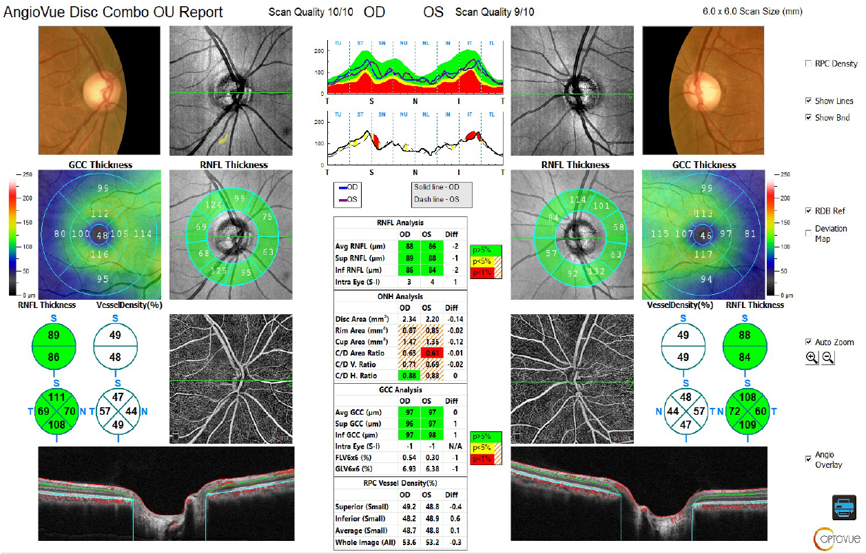 [OCT Article] Managing Glaucoma Risk with Positive Family History