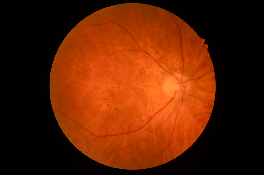 [OCT Article] Choroidal Neovascularization with Optovue Solix